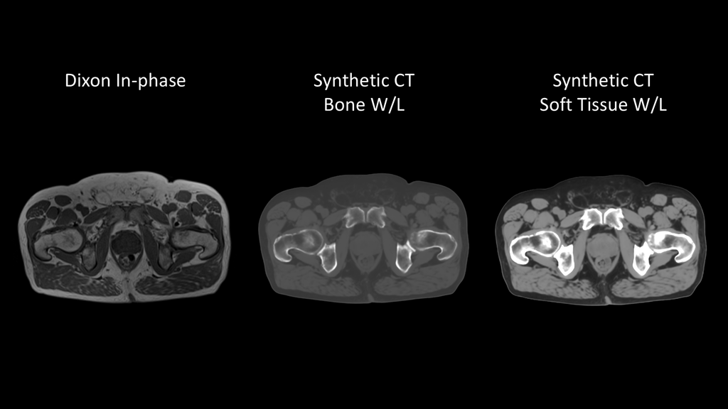 MR-only Radiotherapy Planning - Siemens Healthineers