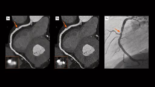 Coronary Stenosis Assessment Prior to a Transcatheter Aortic Valve ...