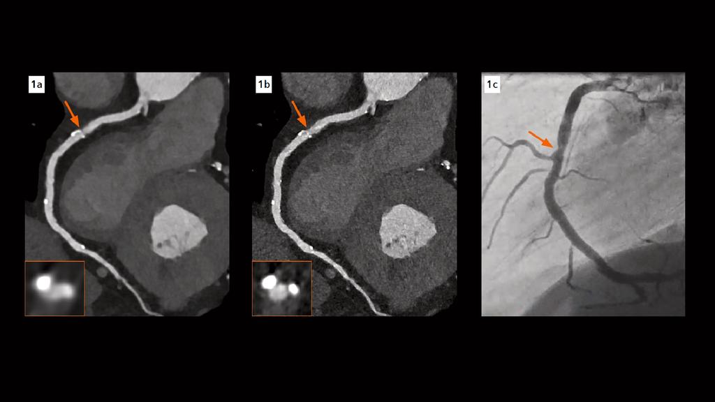 Coronary stenosis assessment prior to a transcatheter aortic valve ...