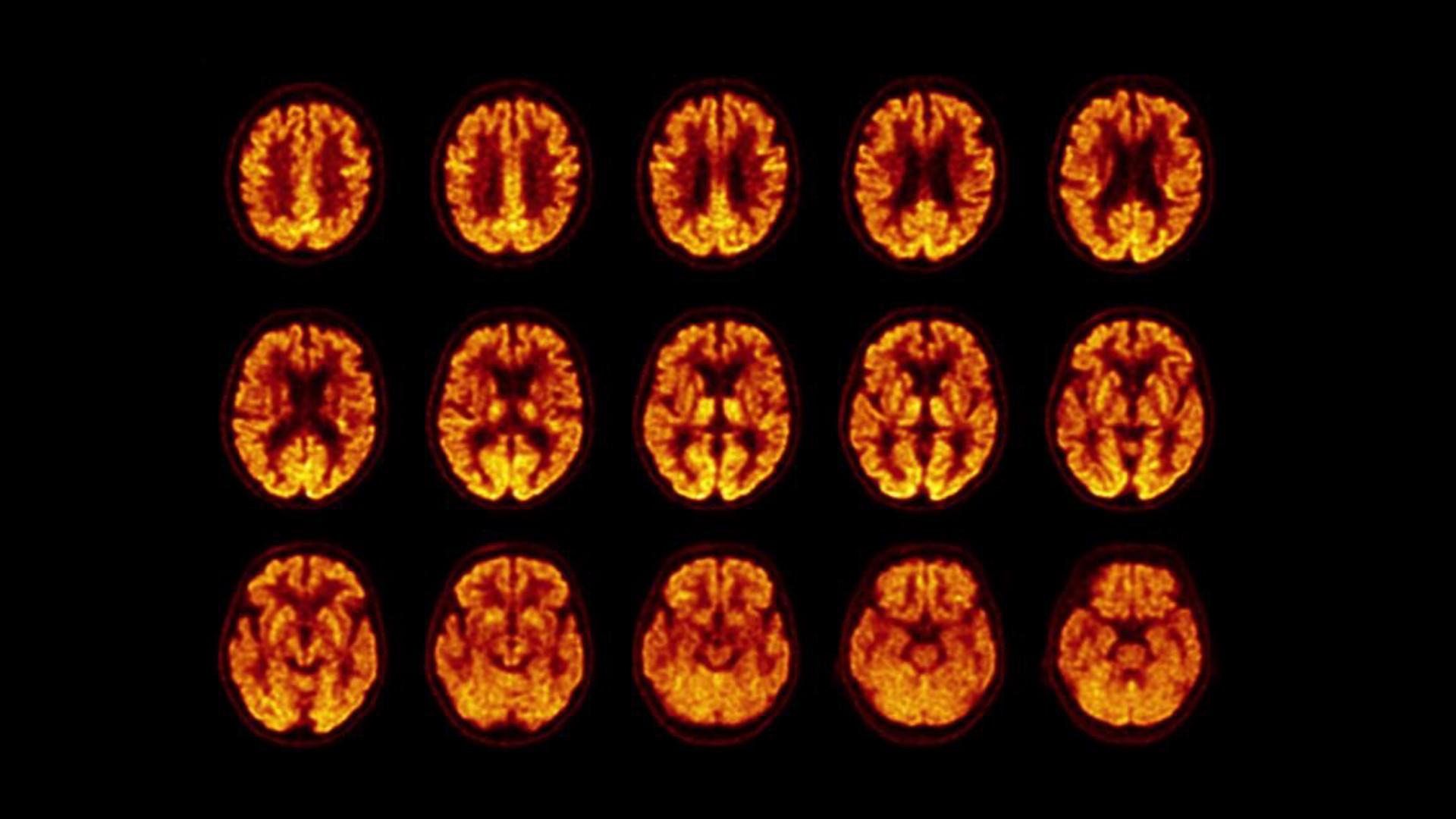 Biograph Trinion PET/CT scanner - Siemens Healthineers