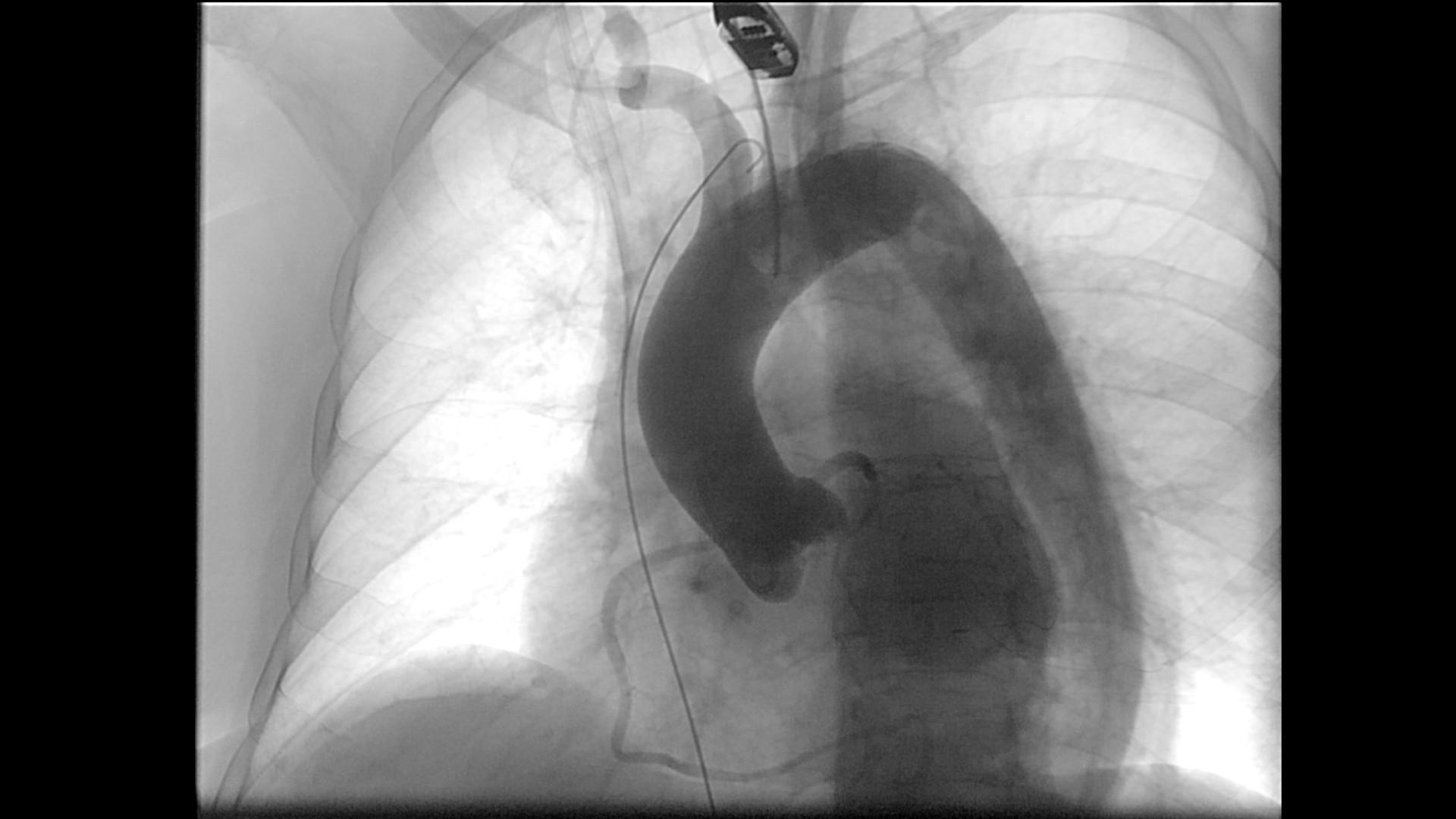 Structural Heart Disease - Siemens Healthineers
