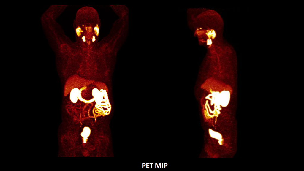 Biograph Vision PET/CT Scanner - Siemens Healthineers