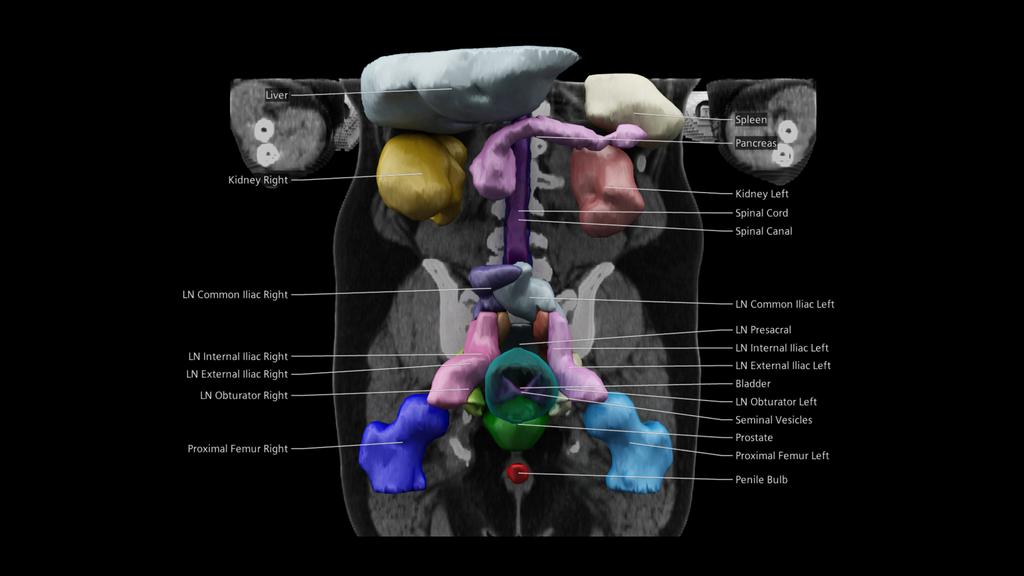 Autocontouring in radiation therapy - Siemens Healthineers - Siemens ...