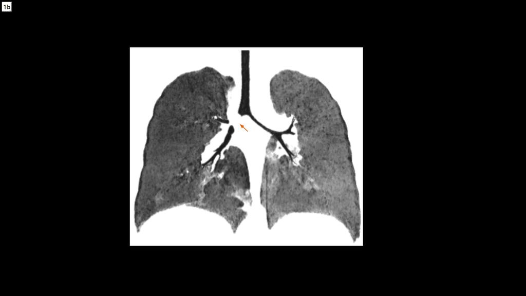 Bronchial Foreign Body Aspiration - Siemens Healthineers USA
