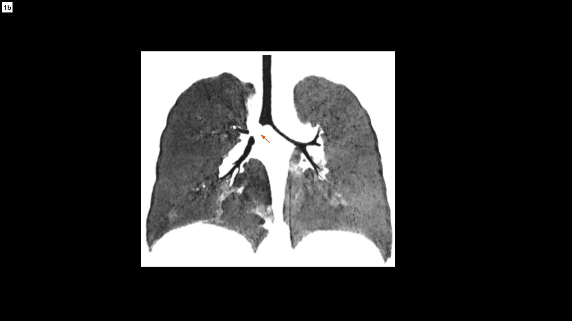 Bronchial Foreign Body Aspiration - Siemens Healthineers