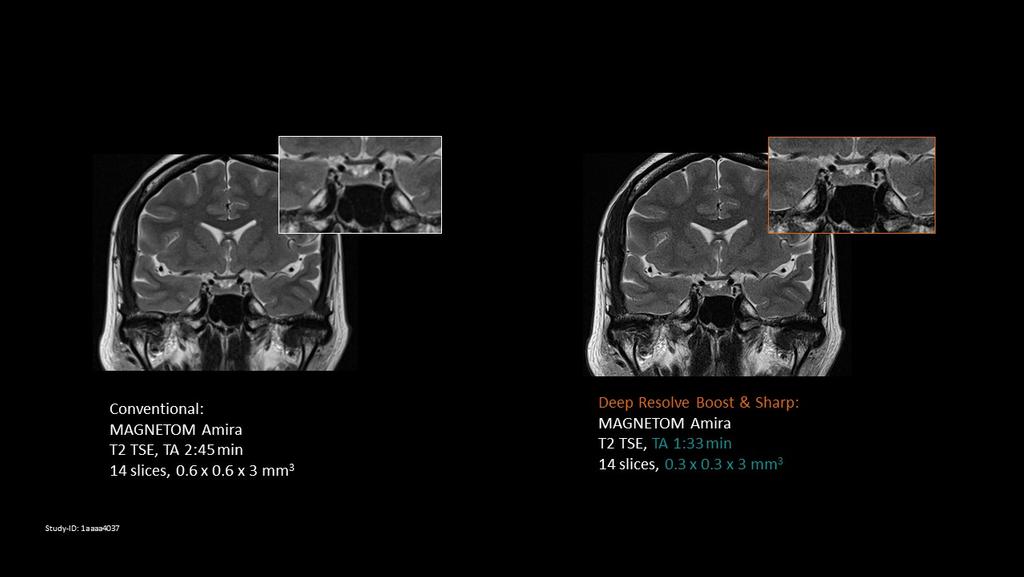 Deep Resolve - Siemens Healthineers USA