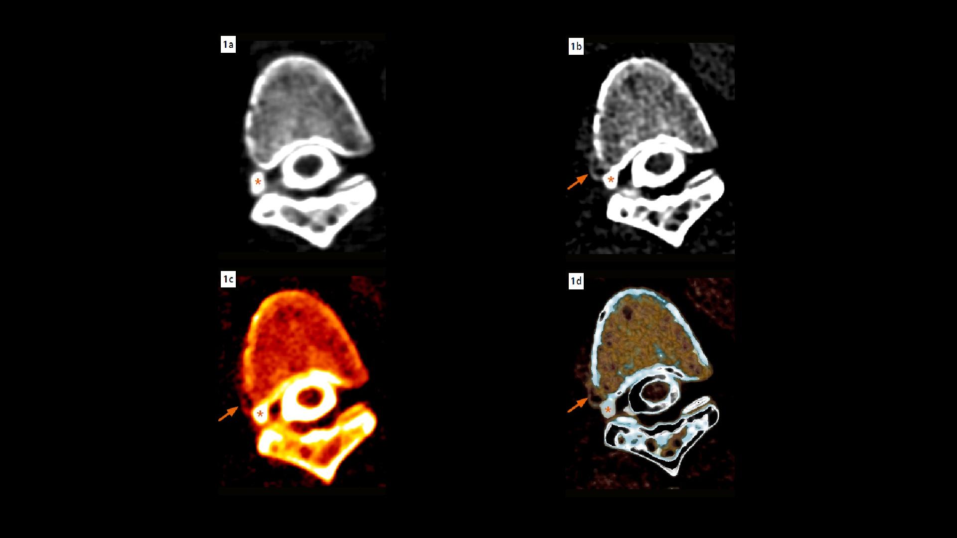 Cerebrospinal fluid-venous fistula detected in a patient with a long ...