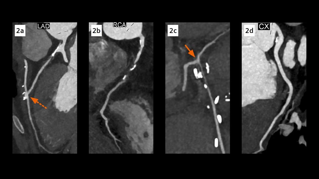 CABG of the right gastroepiploic artery and of the left internal ...