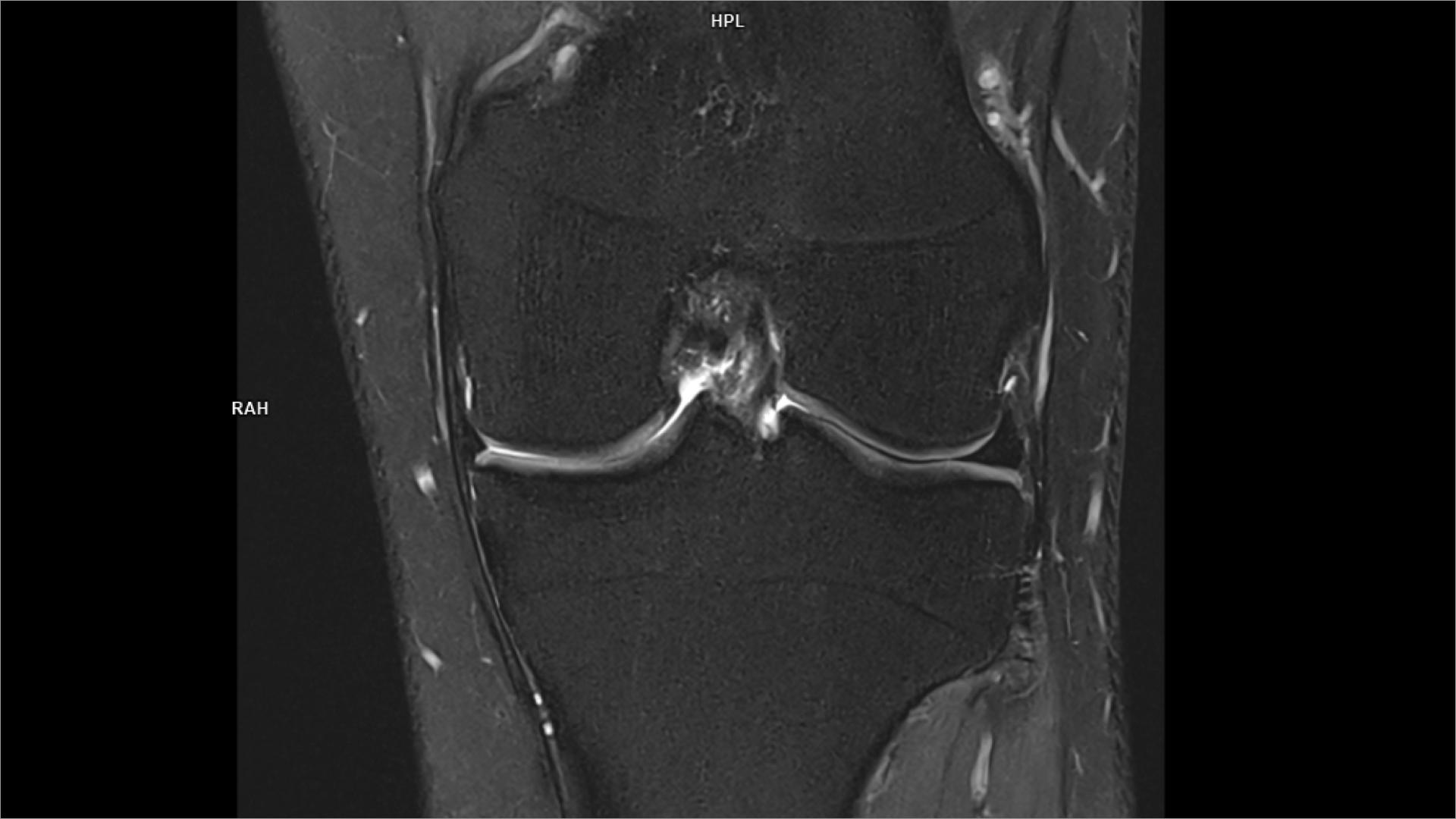 Coronal PD tse FS DR Sharp-MAGNETOM Vida - Siemens Healthineers USA