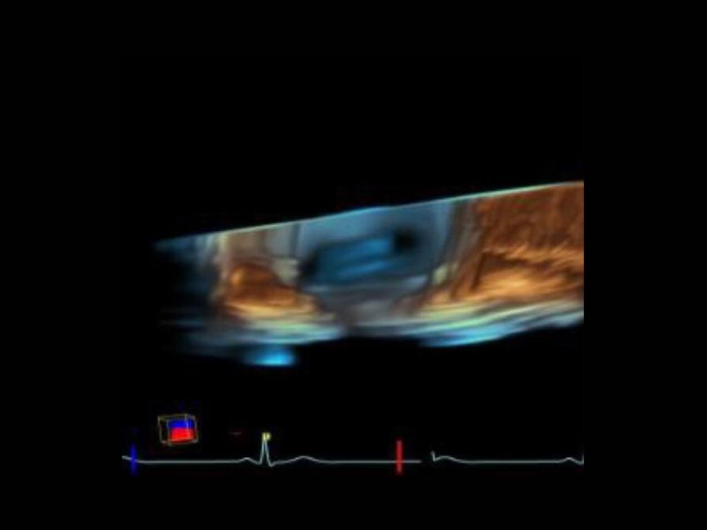 ACUSON AcuNav Volume 4D ICE Catheter - Siemens Healthineers USA