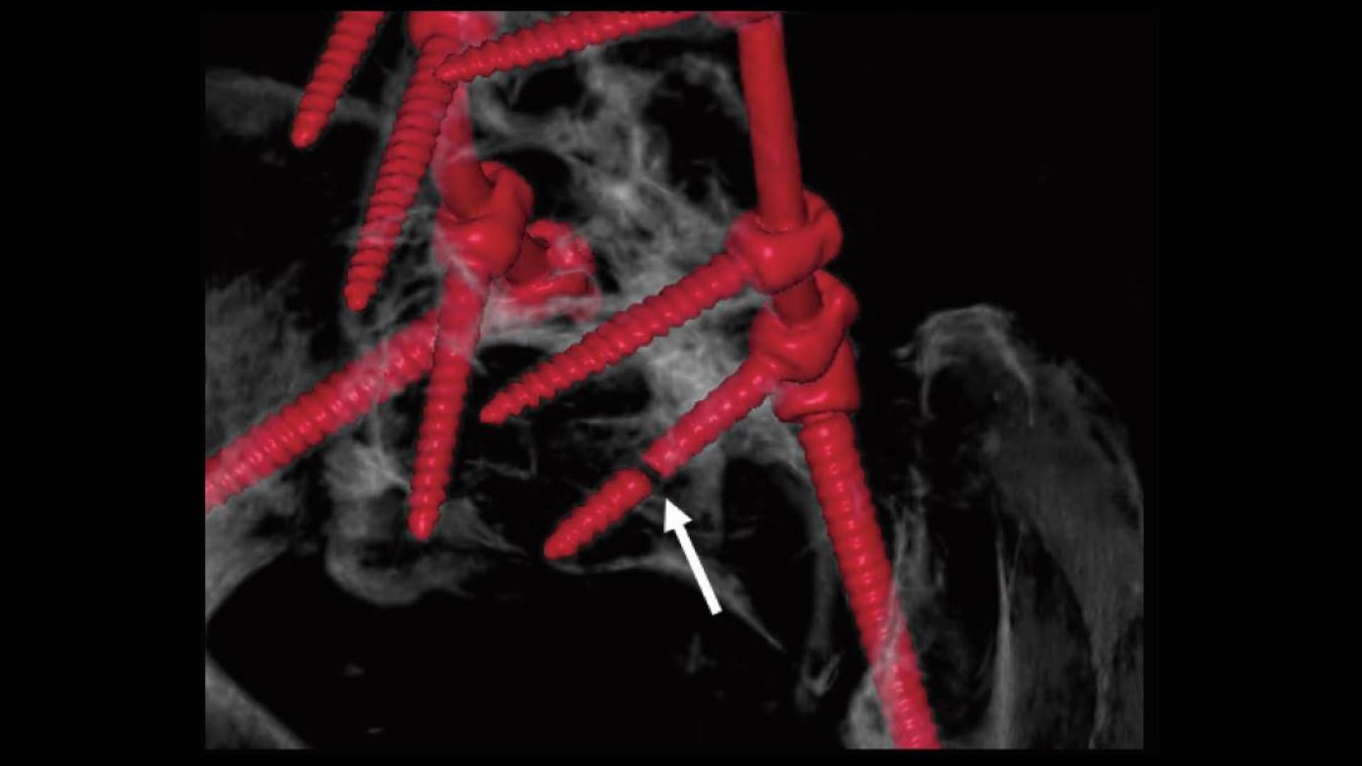 SPECT/CT imaging in the evaluation of pain following spinal fusion ...