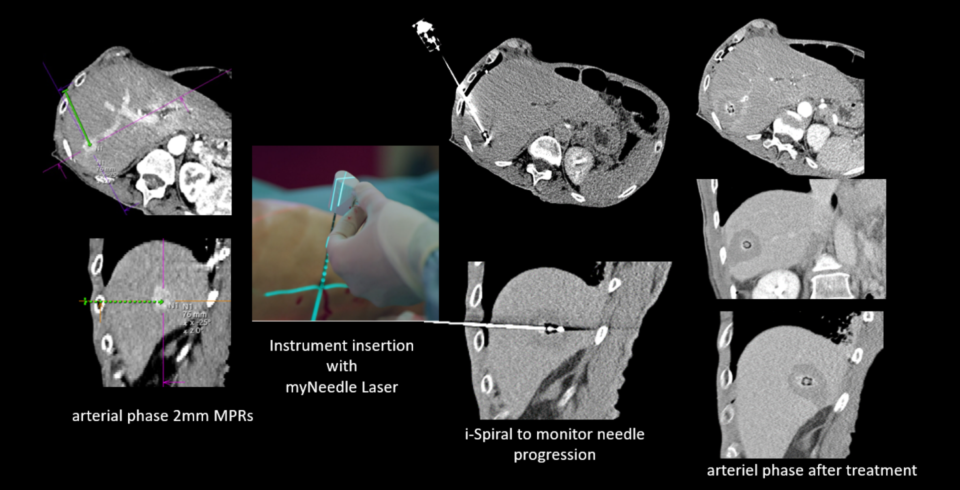 CT-guided interventions - Siemens Healthineers