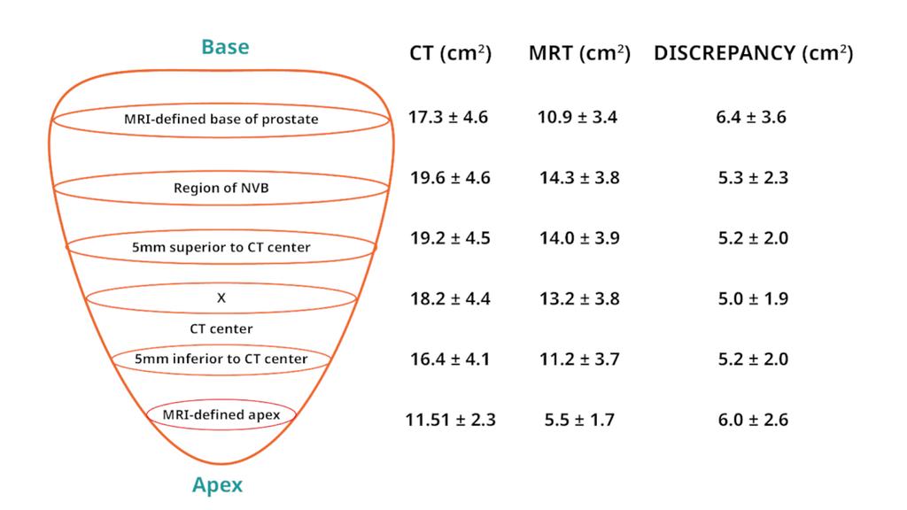 MRI-based simulation and planning for better accuracy and reduced ...