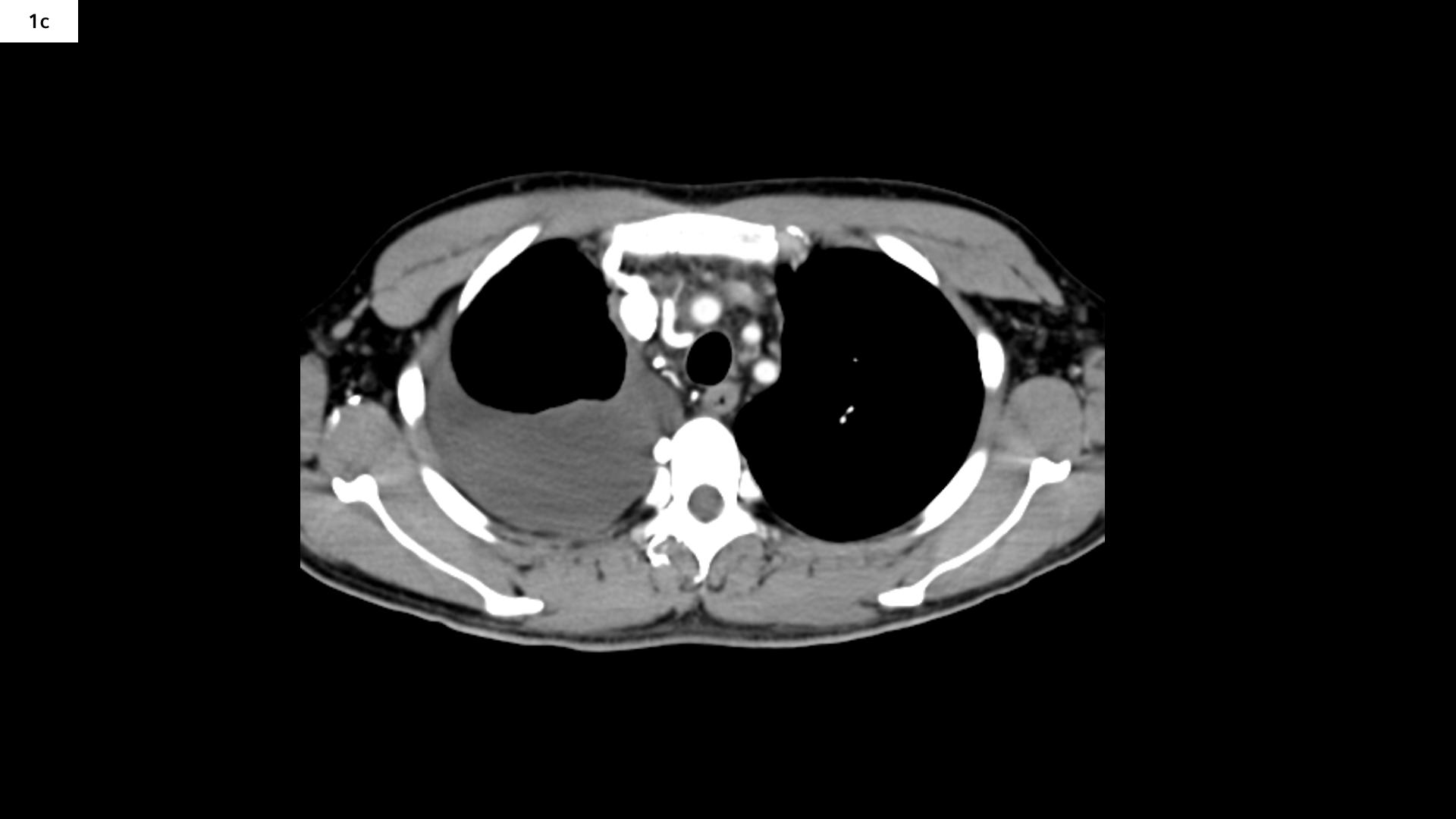 Superior vena cava obstruction caused by a primary mediastinal large B ...