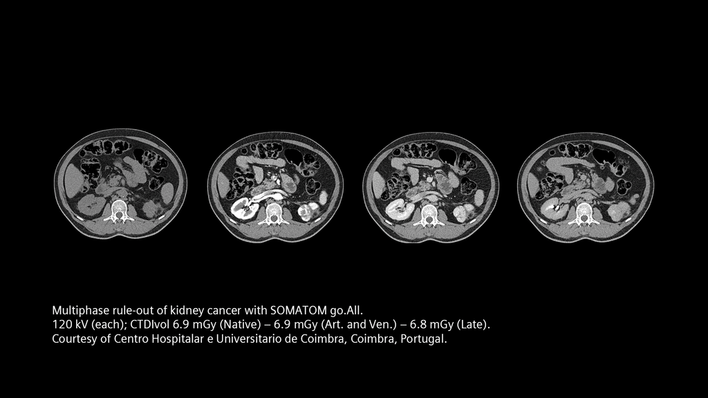 Computed Tomography for Oncology - Siemens Healthineers