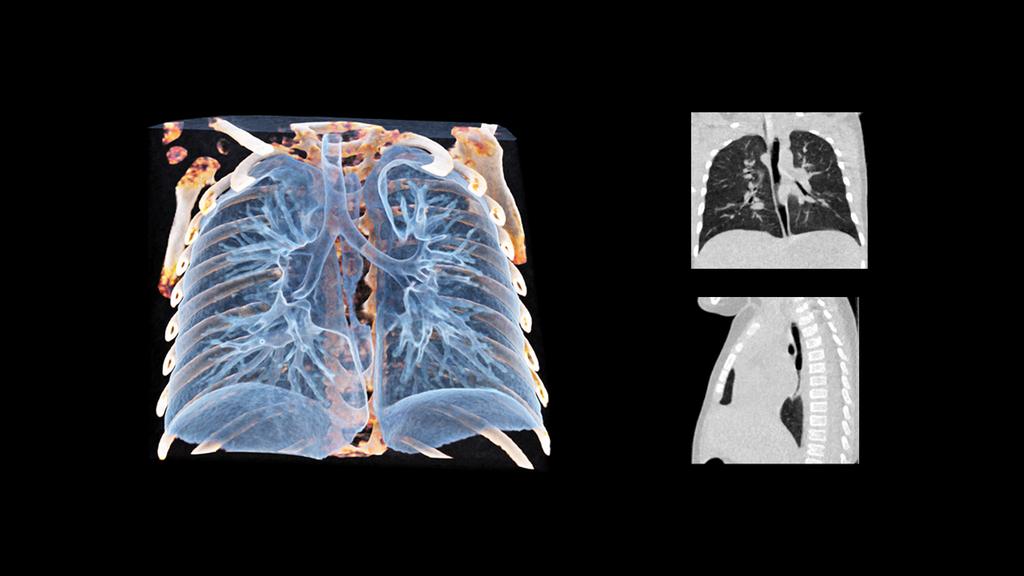SOMATOM Definition Edge - Siemens Healthineers India