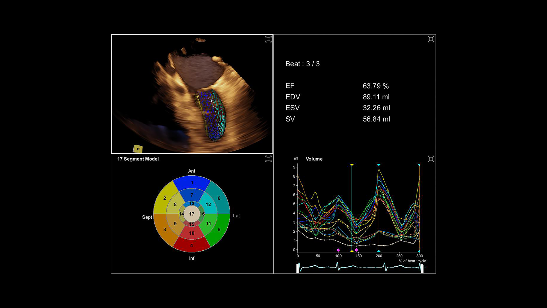 Cardiovascular Ultrasound | ACUSON SC2000 Ultrasound System - Siemens ...