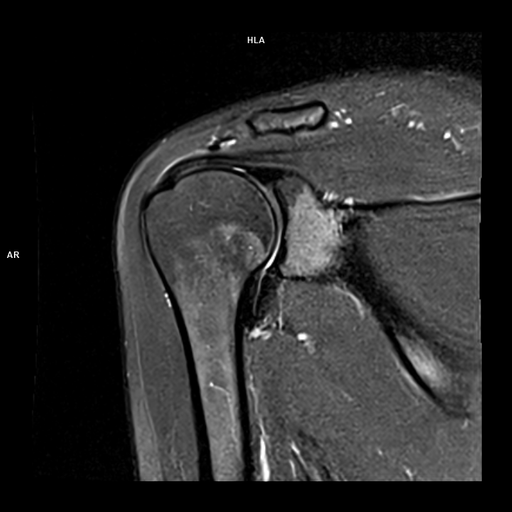 Coronal PD FS-MAGNETOM Free.Max - Siemens Healthineers USA