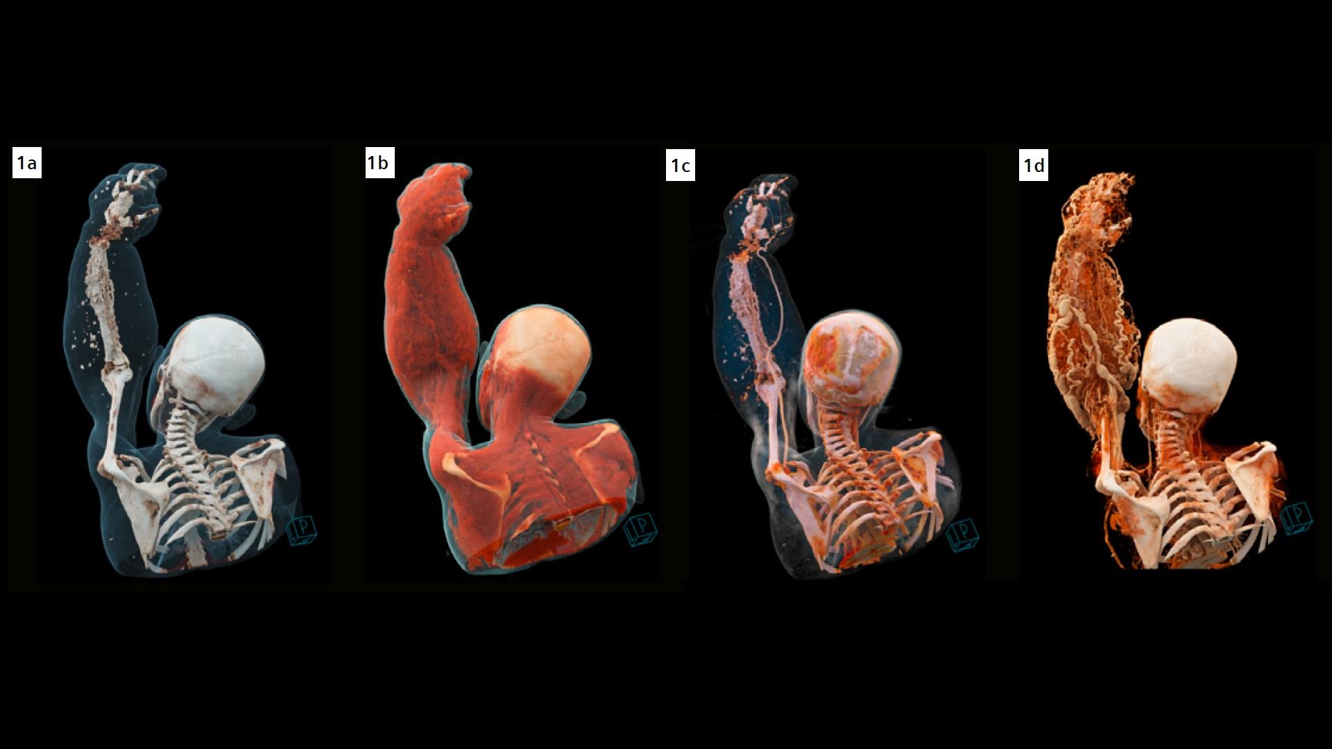 An Excessive Hybrid of Venous Malformation & Venous Hemangioma of the ...