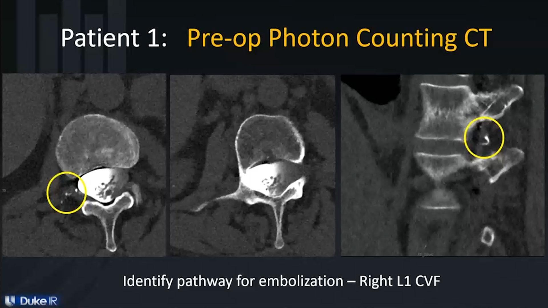 How Photon Counting Detector Ct Impacts On My Clinical Practice Pre