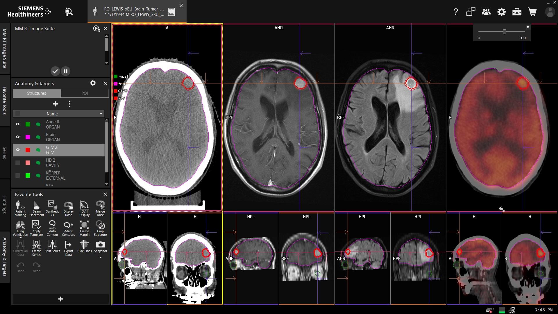 syngo.via RT Image Suite - Siemens Healthineers