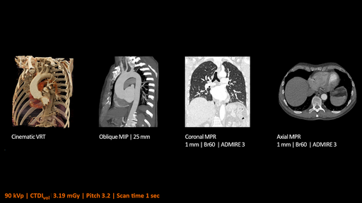 Dual Source CT - Siemens Healthineers