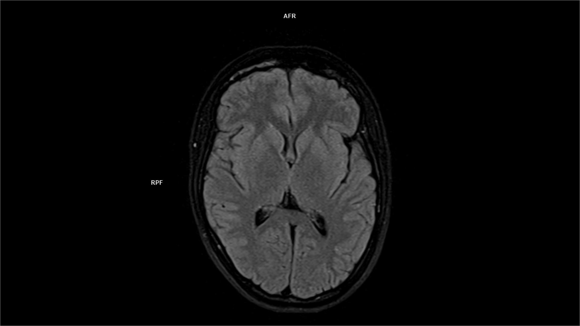 Axial FLAIR-MAGNETOM Free.Max - Siemens Healthineers USA