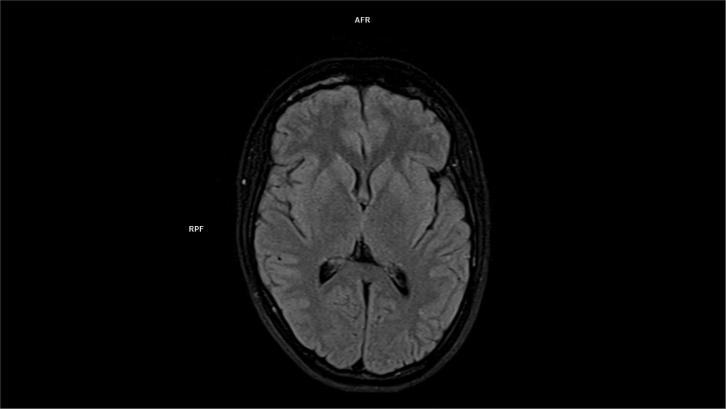 Axial FLAIR-MAGNETOM Free.Max - Siemens Healthineers USA