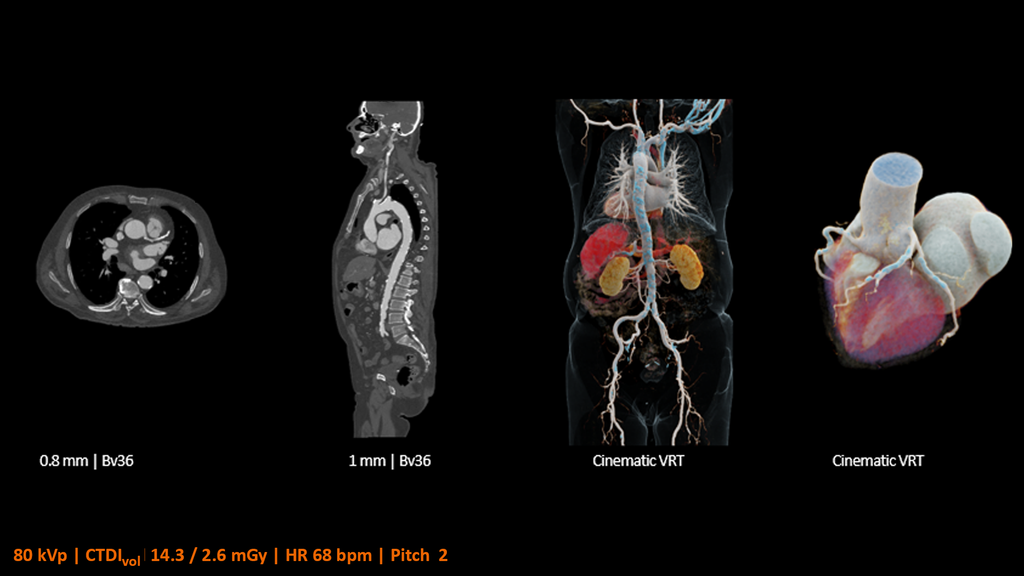 Dual Source CT - Siemens Healthineers