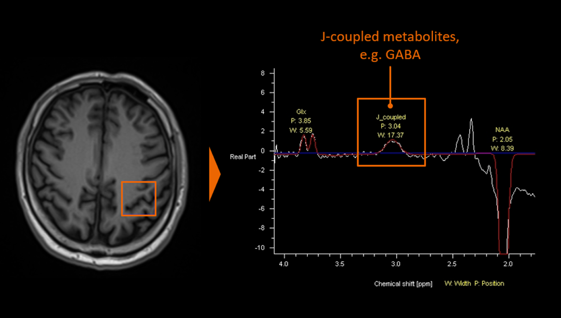 Single-Voxel Spectroscopy Edit - Siemens Healthineers USA