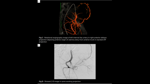 Three-Dimensional Rotational Angiography in Uterine Fibroid Embolization