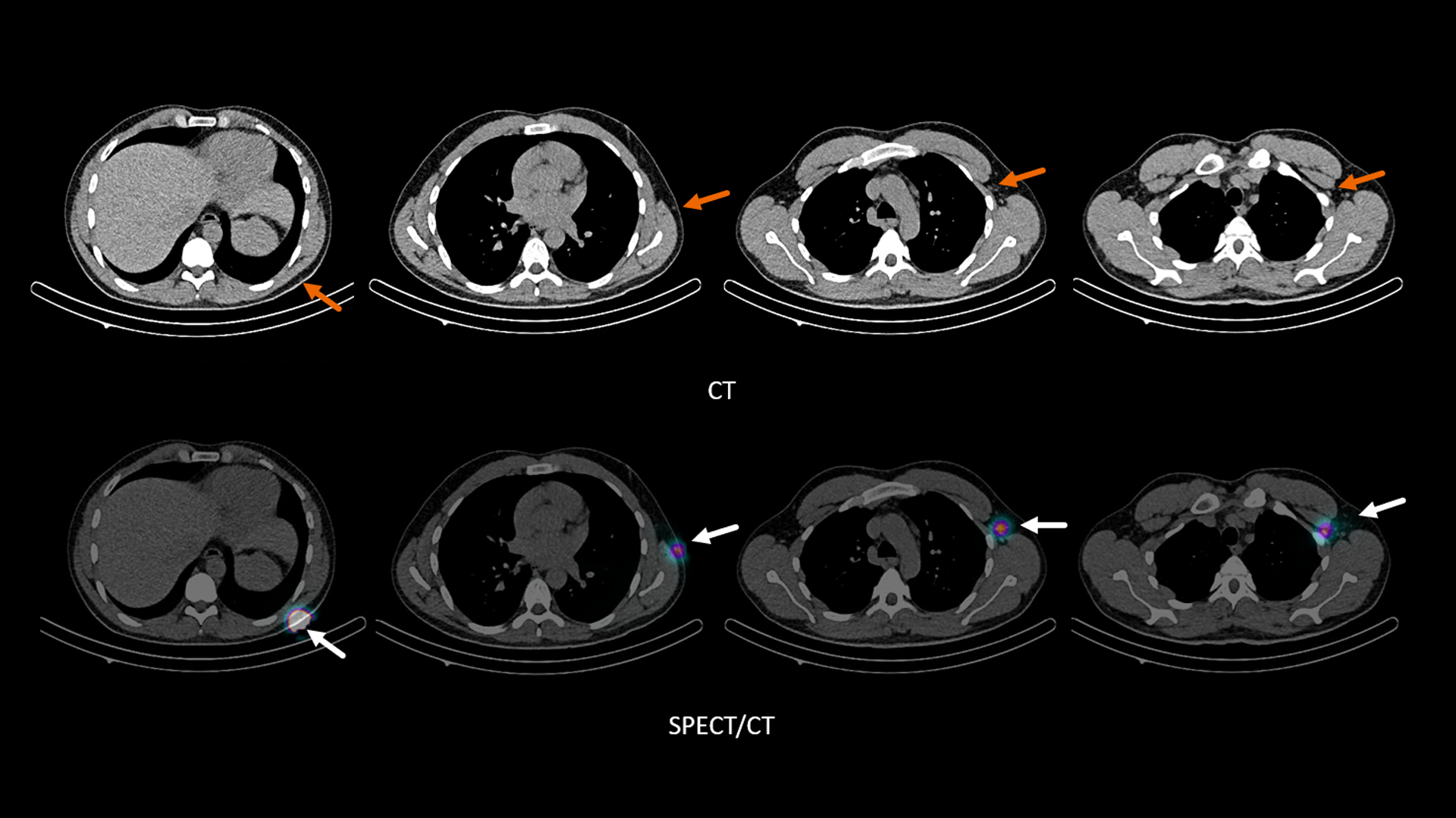 Symbia Pro.specta SPECT/CT Case Study Review - Siemens Healthineers Romania