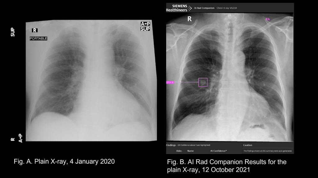 How AI can increase accuracy in Chest X-ray and enhance incidental findings