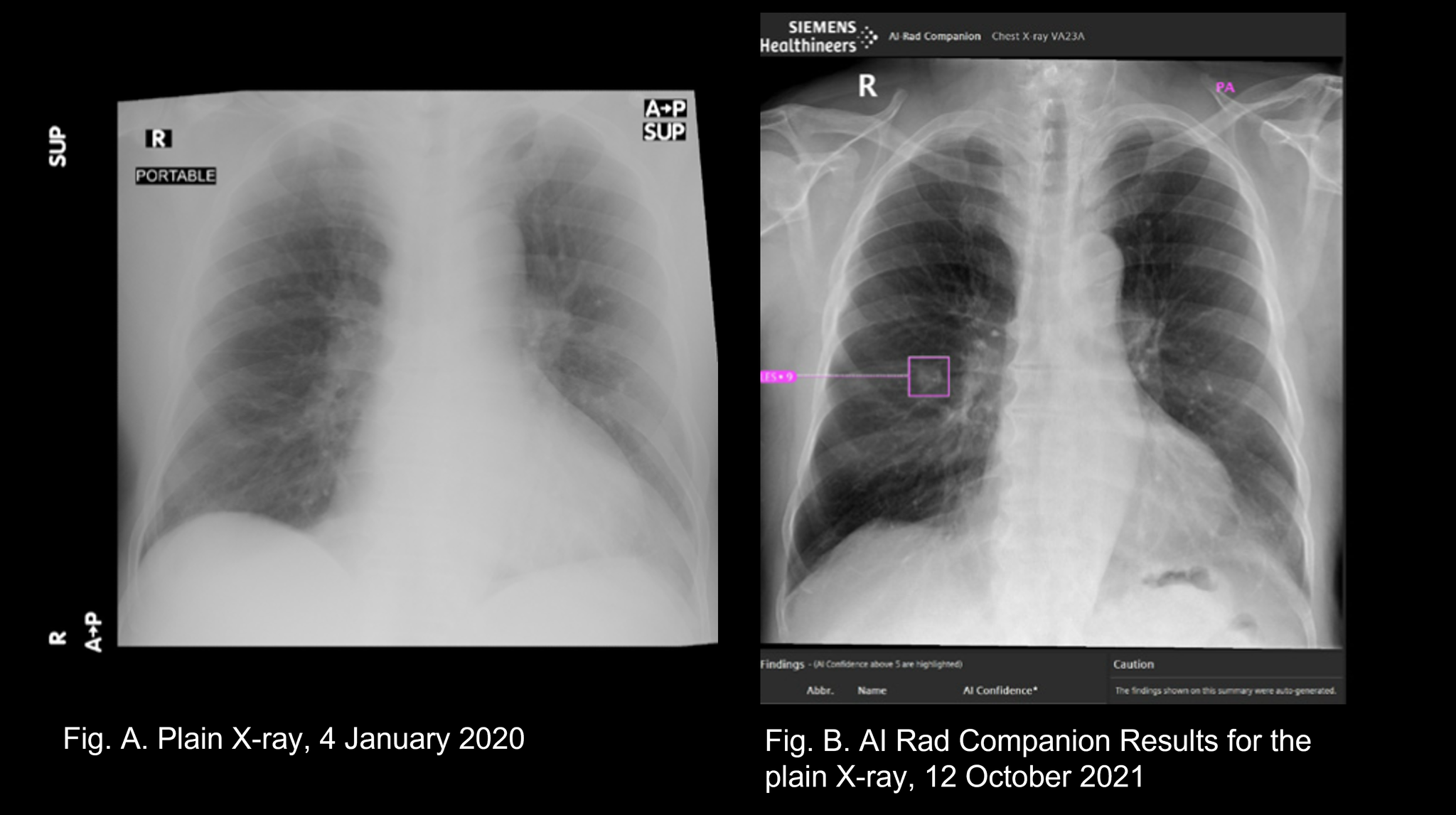 How AI can increase accuracy in Chest X-ray and enhance incidental findings