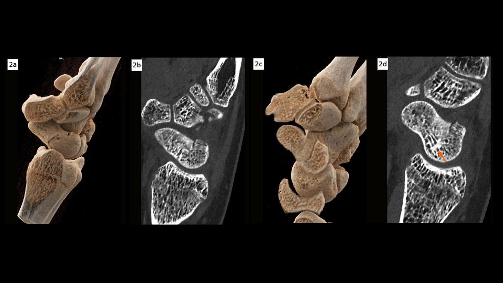 Scaphoid fracture only seen in CT - Siemens Healthineers