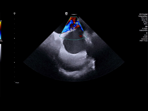 Intracardiac Echocardiography with AcuNav Ultrasound Catheters ...
