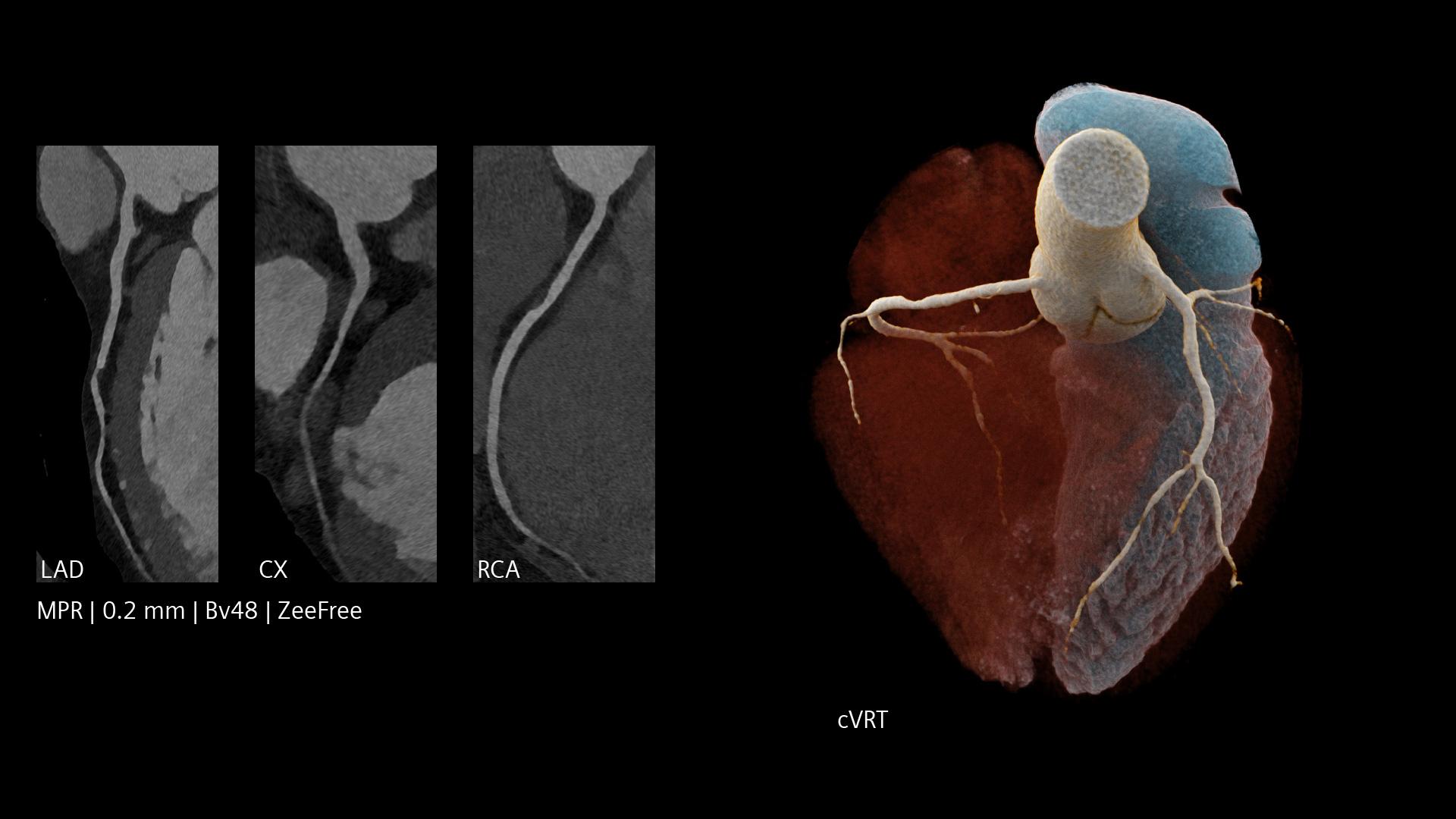 PCCT cardiovascular imaging - Siemens Healthineers