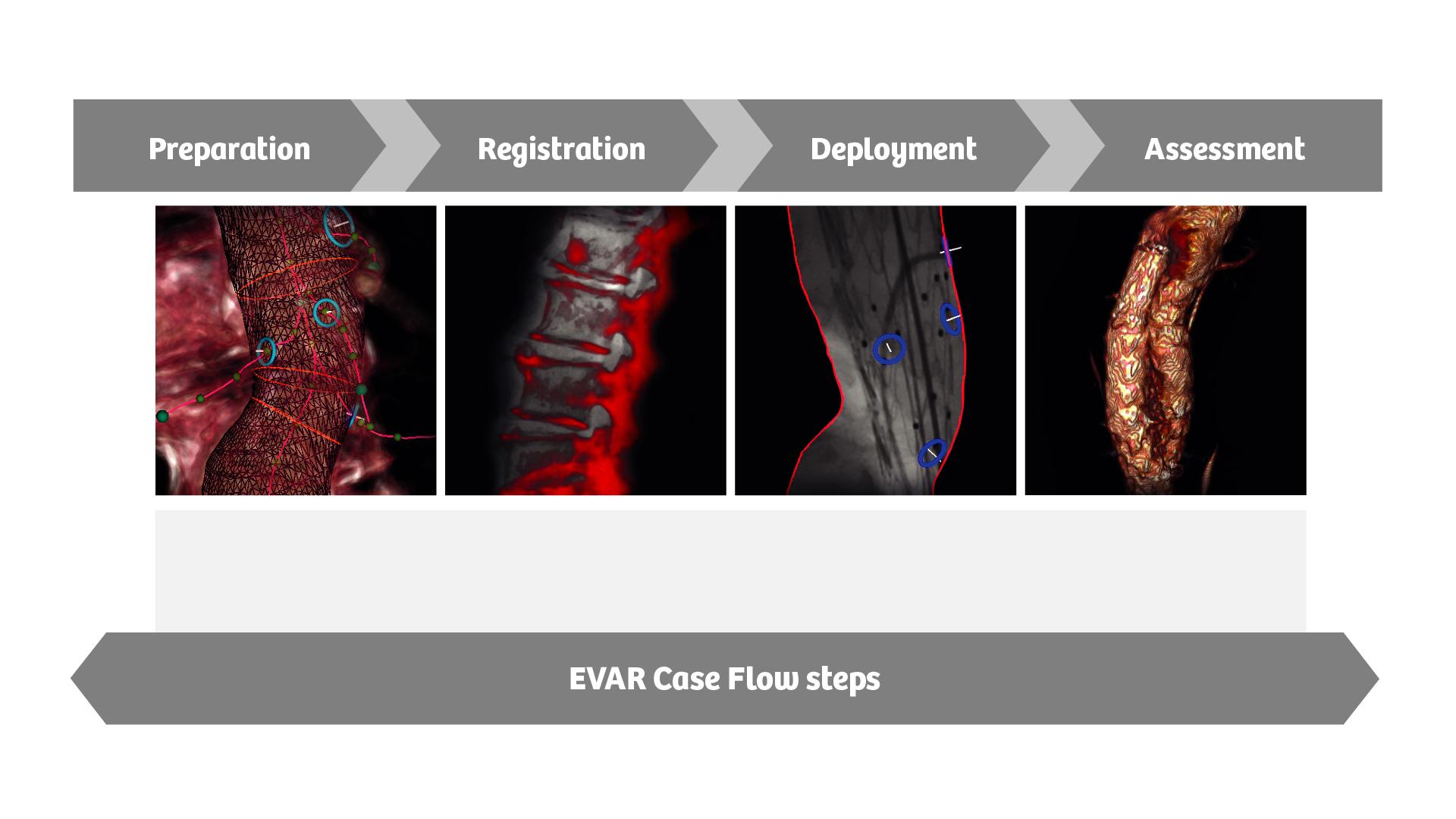 EVAR in the Hybrid OR