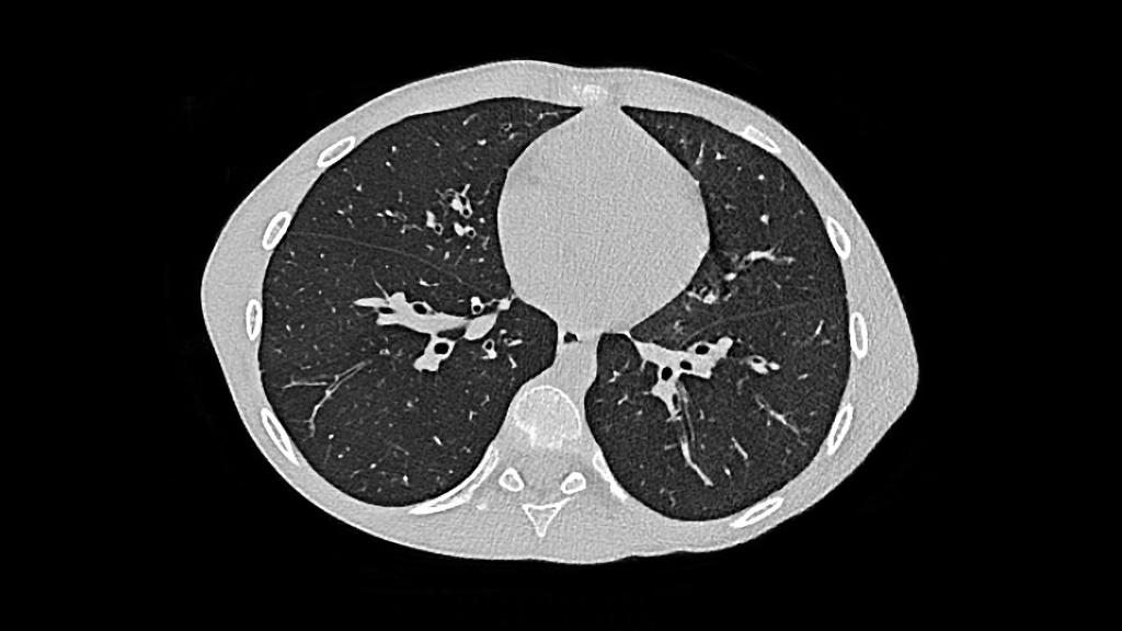 PCCT pulmonology imaging - Siemens Healthineers