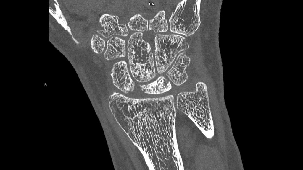 NAEOTOM Alpha photon-counting CT scanner - Siemens Healthineers Canada