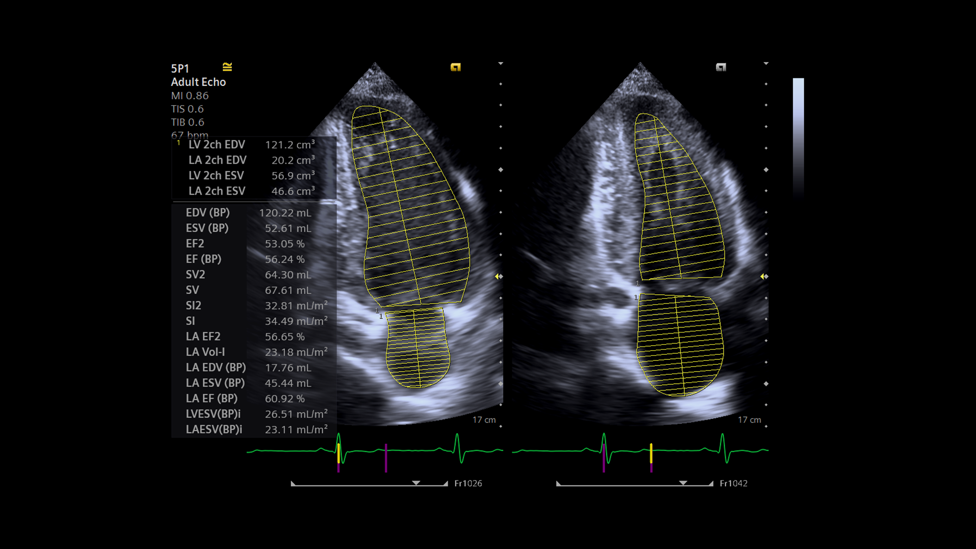 ACUSON Juniper, CV Edition Ultrasound System - Siemens Healthineers