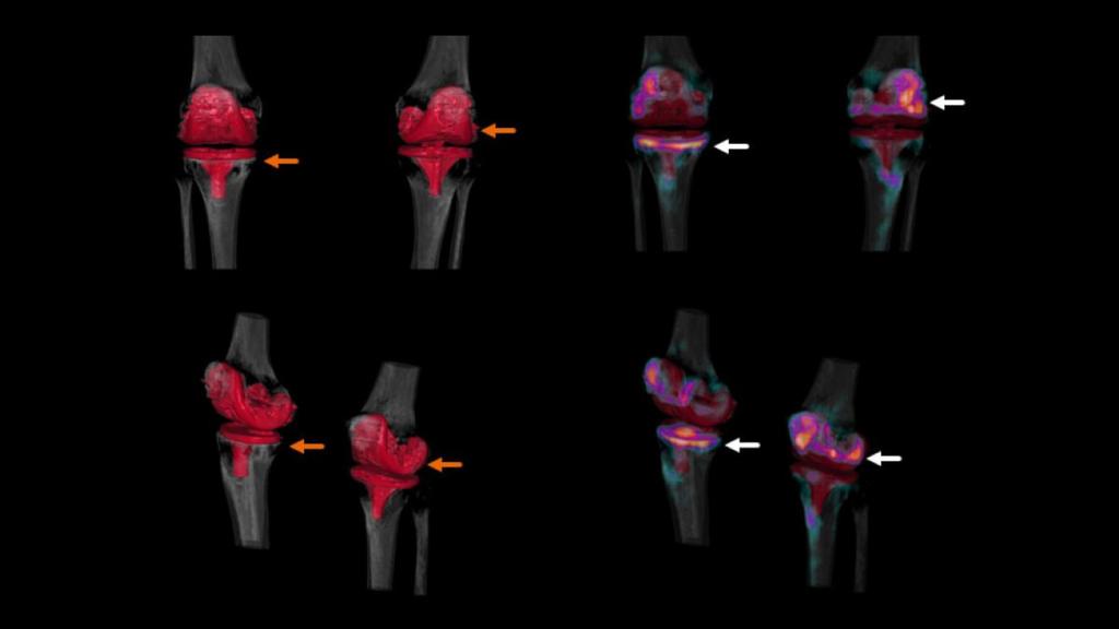 SPECT/CT Detection In TKA Prosthetic Loosening - Siemens Healthineers USA