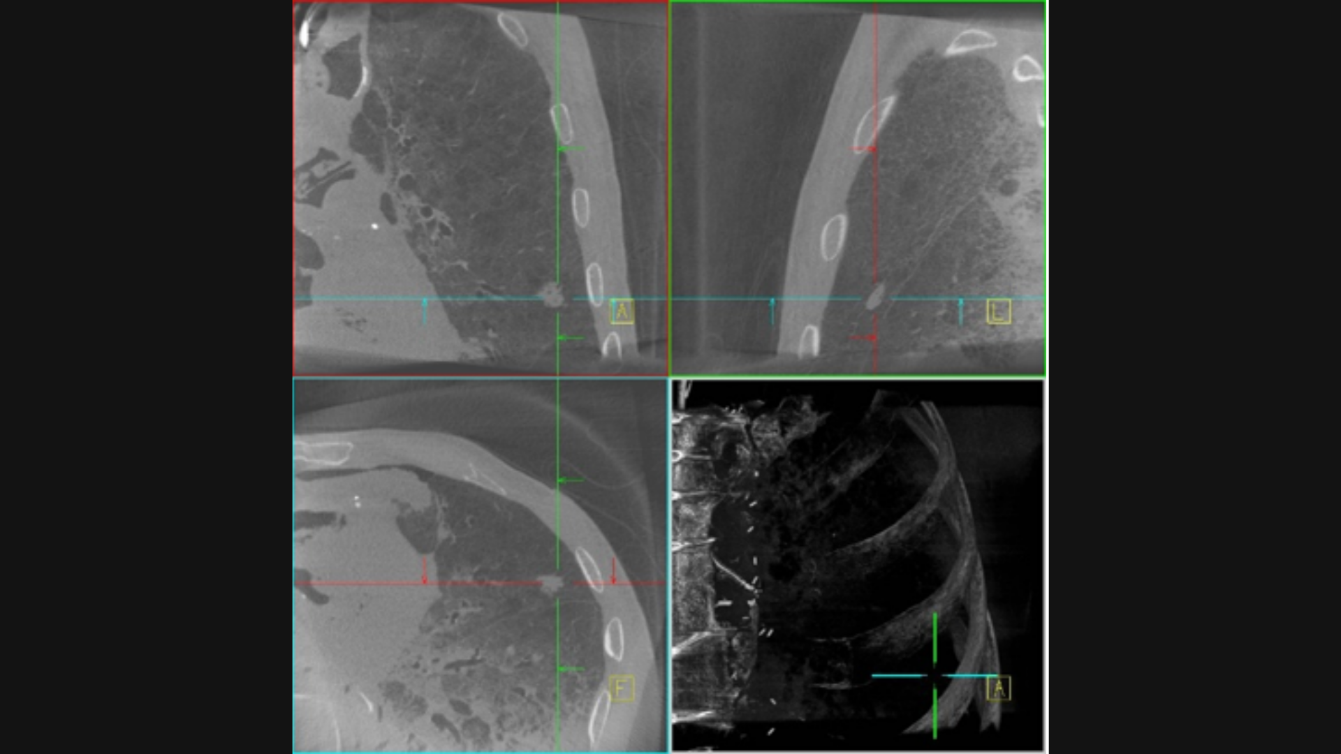 Lung Care Imaging Solutions - Siemens Healthineers USA