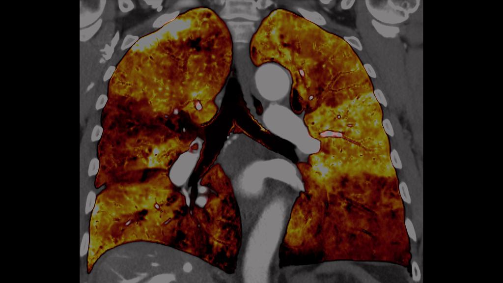 PCCT pulmonology imaging - Siemens Healthineers