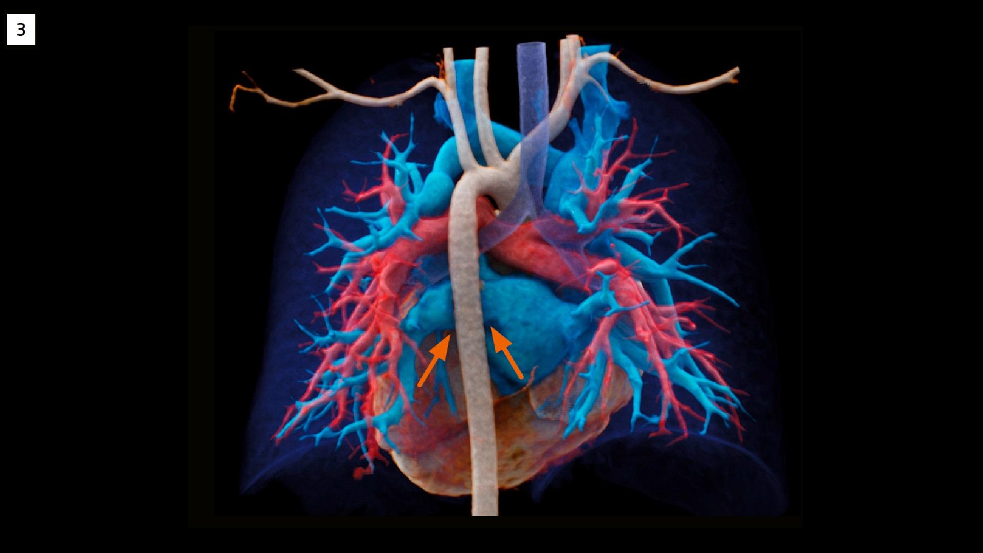 Anomalous pulmonary venous connection – total or partial? - Siemens ...