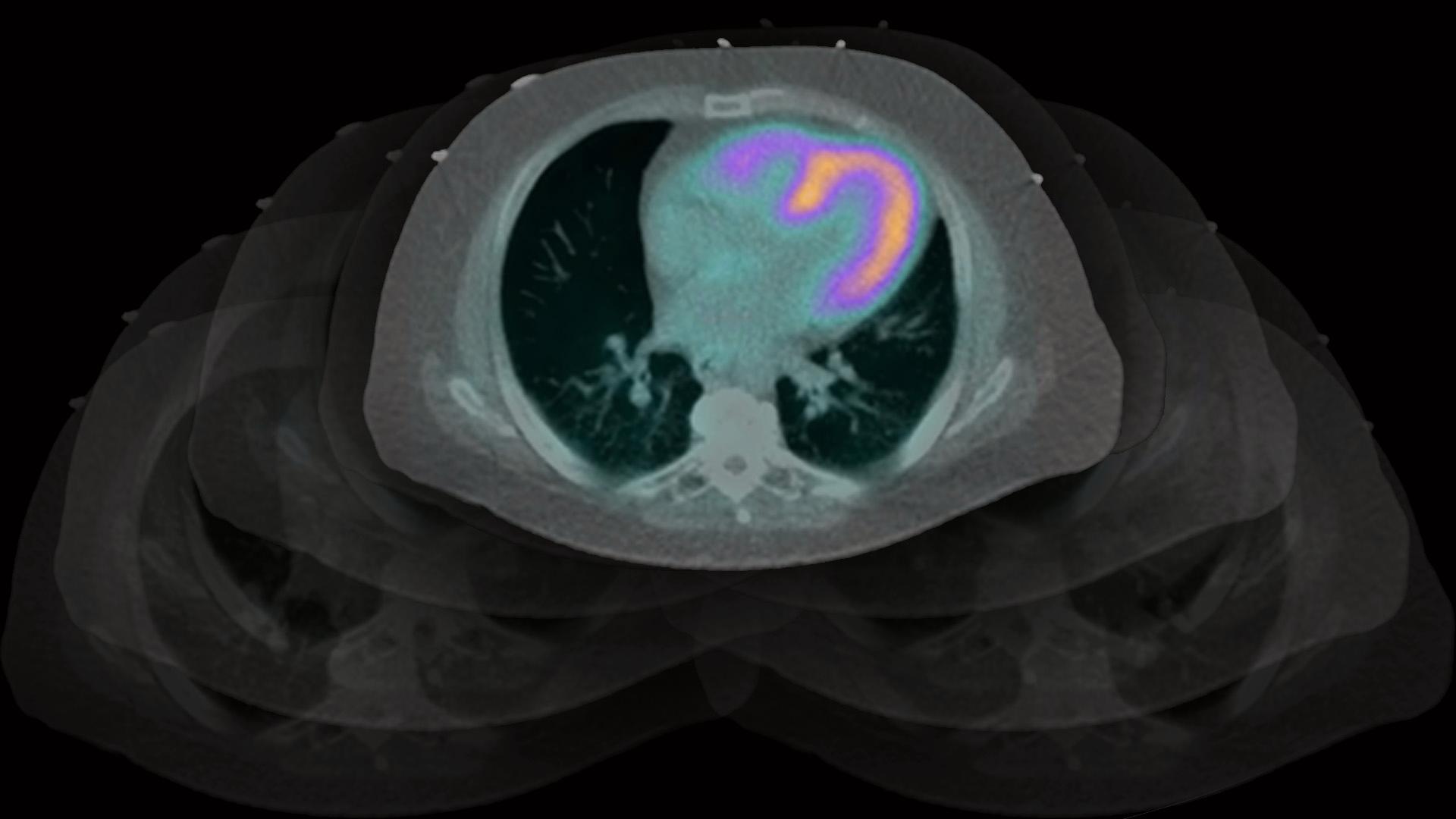 PETNET on cardiology - Siemens Healthineers