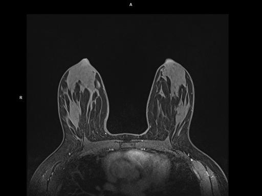 NeoCoil - Siemens Healthineers USA