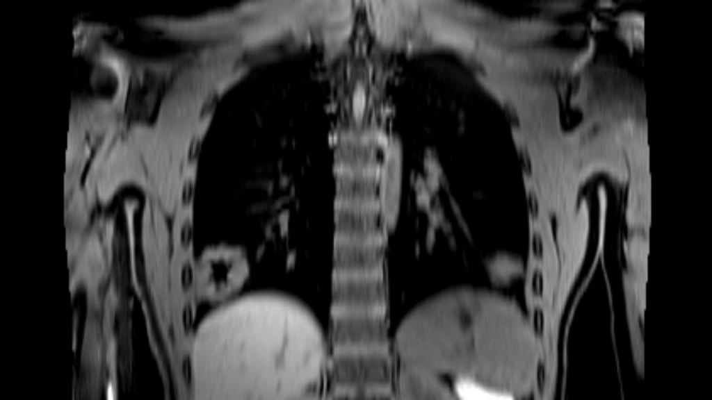 Pulmonary MRI - Siemens Healthineers