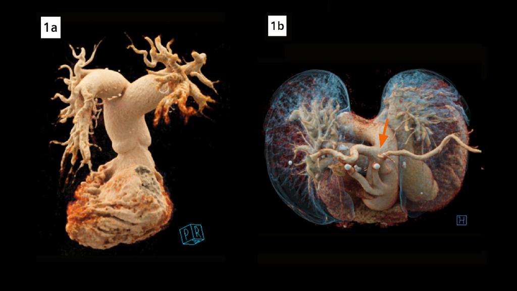Chronic thromboembolic pulmonary hypertension - Siemens Healthineers