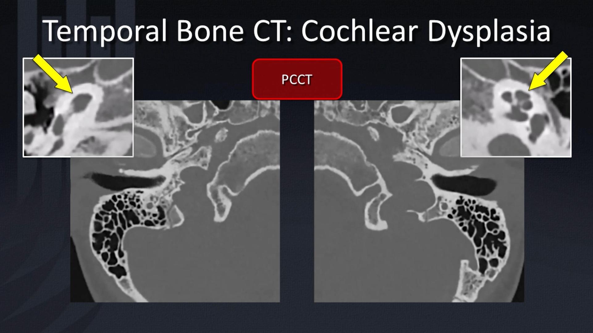 Photon-counting CT in Neuroradiology - Siemens Healthineers USA